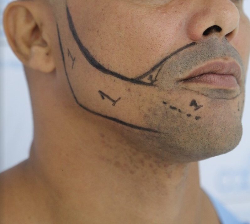 Transplante de Barba - Mais Cabello