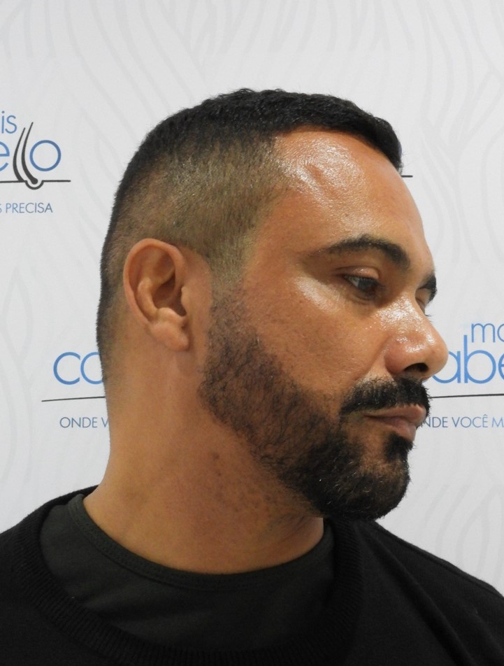Transplante de Barba - Mais Cabello