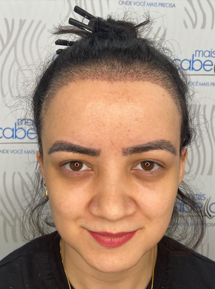 Transplante de Sobrancelhas - Mais Cabello